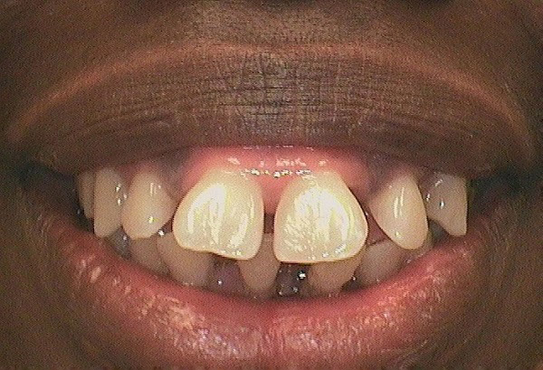 Before & After Dental Photos Houston Texas, Smile Gallery